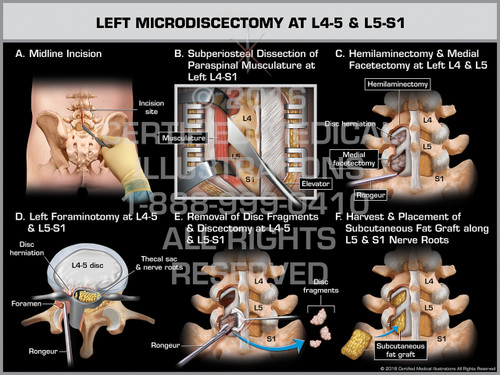 Left Microdiscectomy at L4-5 & L5-S1 - Print Quality Instant Download
