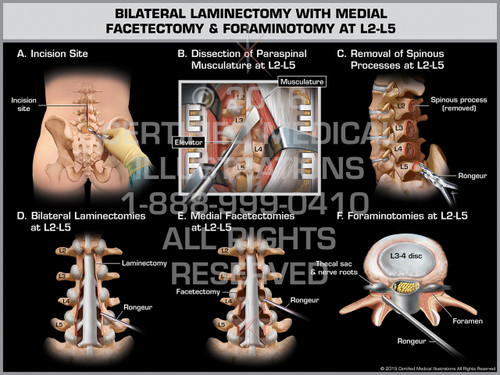 Bilateral Laminectomy with Medial Facetectomy & Foraminotomy at L2-L5 ...