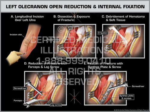 Left Olecranon Open Reduction & Internal Fixation - Print Quality ...