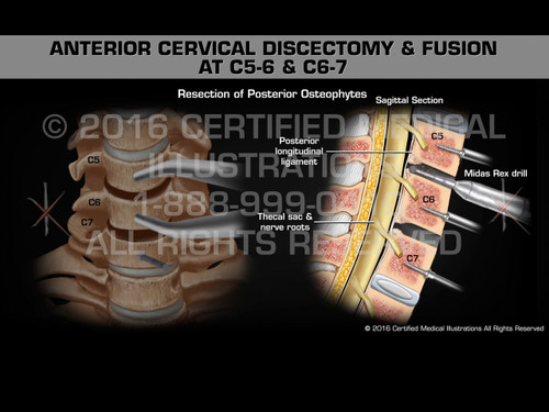 Anterior Cervical Discectomy & Fusion at C5-6 & C6-7 - Medical Animation
