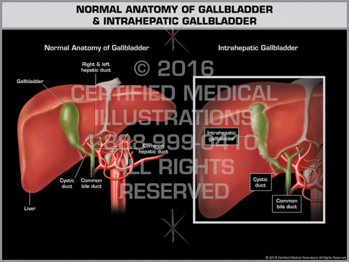 Normal Anatomy of Gallbladder & Intrahepatic Gallbladder - Print ...