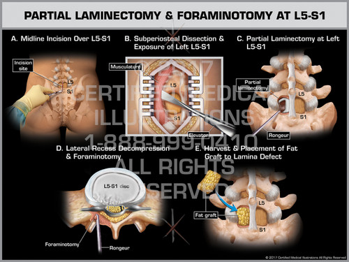 Partial Laminectomy & Foraminotomy at L5-S1