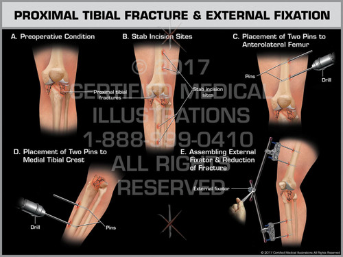 Proximal Tibial Fracture & External Fixation- Print Quality Instant ...