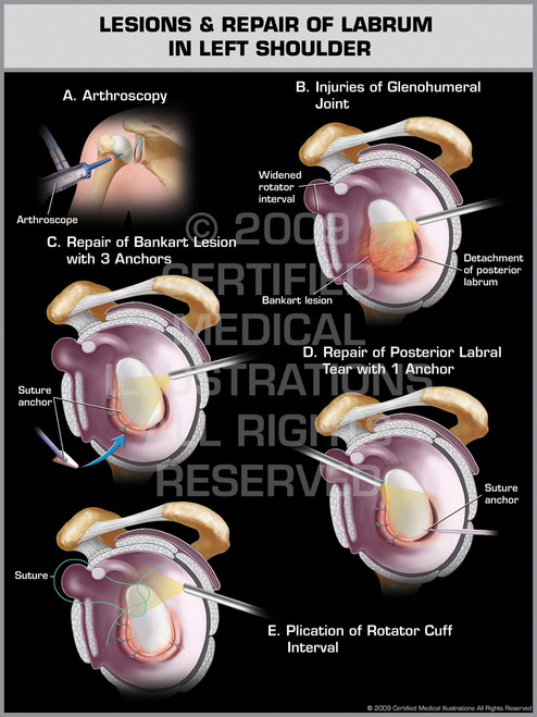 Lesions & Repair of Labrum in Left Shoulder