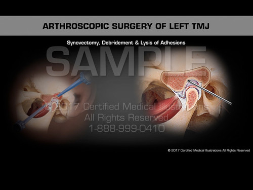 Arthroscopic Surgery of Left TMJ- Medical Animation