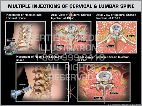 Multiple Injections of Cervical & Lumbar Spine