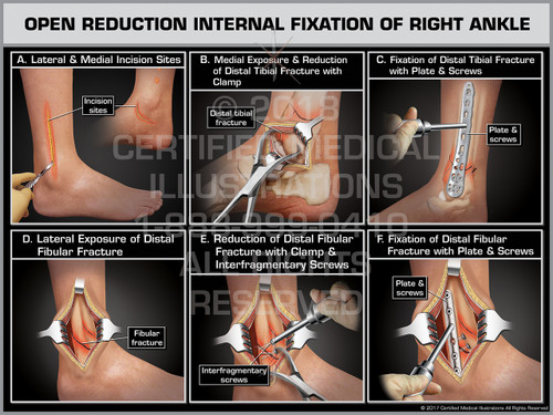 Open Reduction Internal Fixation of Right Ankle