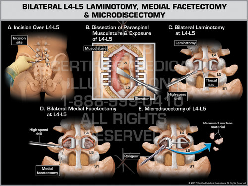 Bilateral L4-L5 Laminotomy, Medial Facetectomy & Microdiscectomy