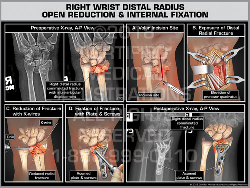Right Wrist Distal Radius Open Reduction & Internal Fixation