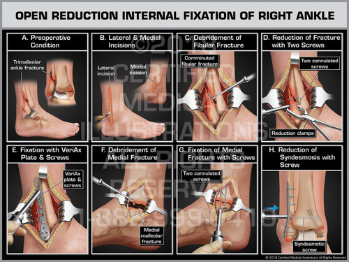 Open Reduction Internal Fixation of Right Ankle
