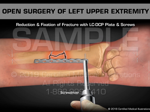 Open Surgery of Left Upper Extremity - Medical Animation