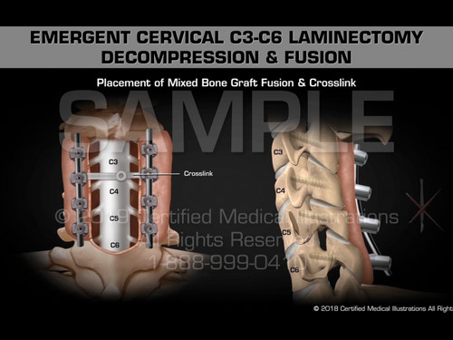 Emergent Cervical C3-C6 Laminectomy Decompression & Fusion - Medical ...
