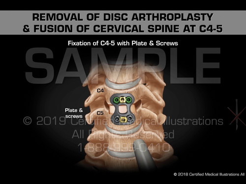 Removal of Disc Arthroplasty & Fusion of Cervical Spine at C4-5 ...