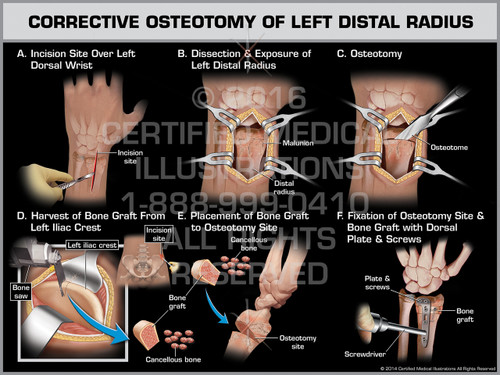 Corrective Osteotomy of Left Distal Radius
