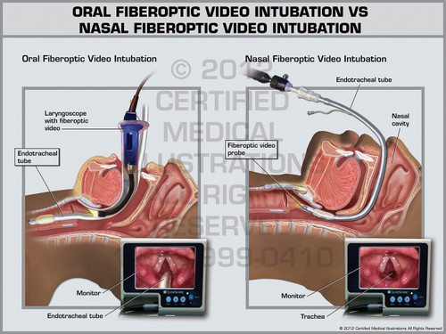Oral Fiberoptic Video Intubation vs Nasal Fiberoptic Video Intubation