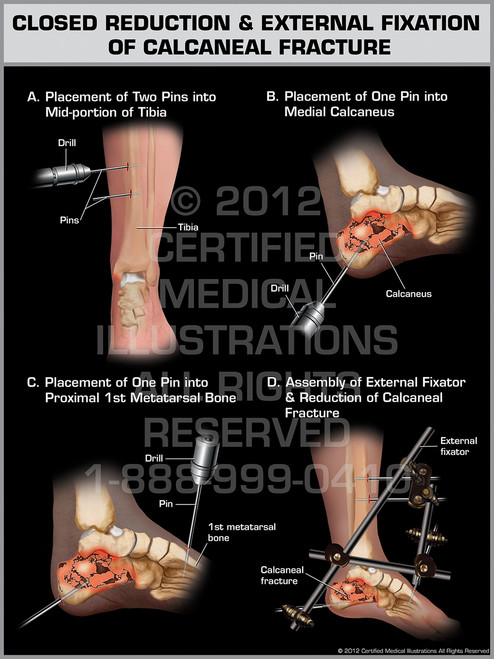 Closed Reduction & External Fixation of Calcaneal Fracture