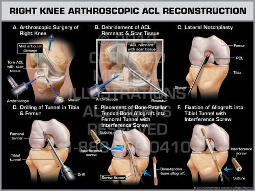 Right Knee Arthroscopic ACL Reconstruction