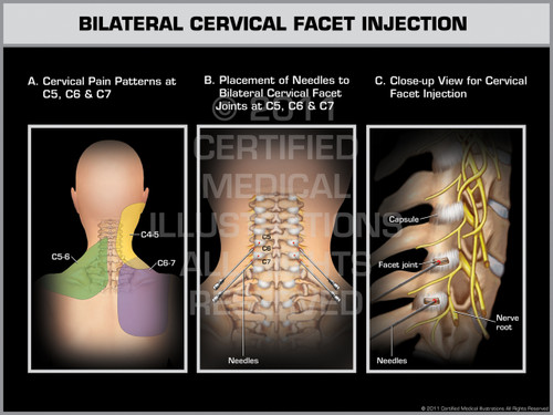 Bilateral Cervical Facet Injection