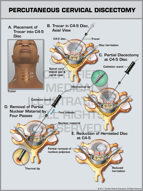 Percutaneous Cervical Discectomy