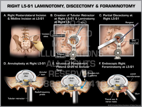Right L5-S1 Laminotomy, Discectomy & Foraminotomy