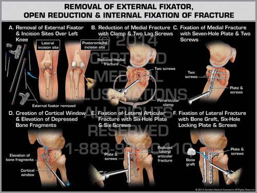 Removal of External Fixator, Open Reduction & Internal Fixation of Fracture