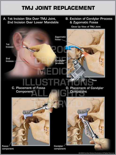TMJ Joint Replacement