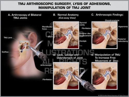 TMJ Arthroscopic Surgery, Lysis of Adhesions, Manipulation of TMJ Joint
