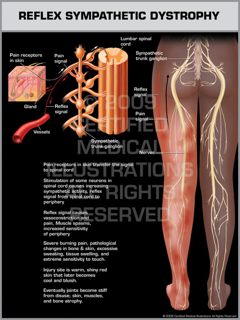 Reflex Sympathetic Dystrophy Lower Limb