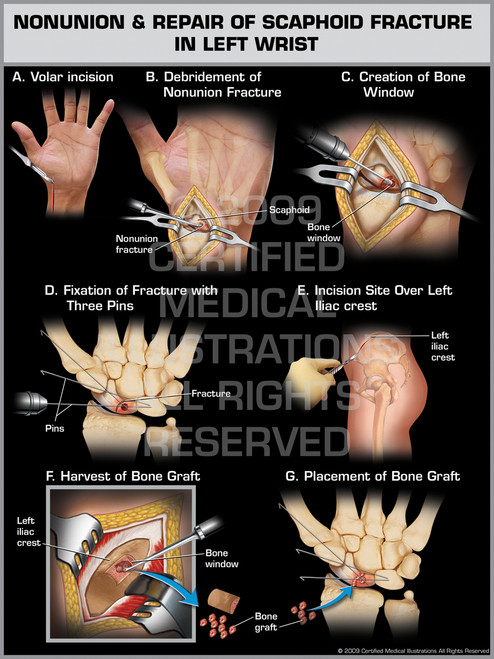 Nonunion & Repair of Scaphoid Fracture in Left Wrist
