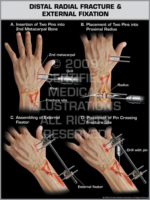 Distal Radial Fracture & External Fixation