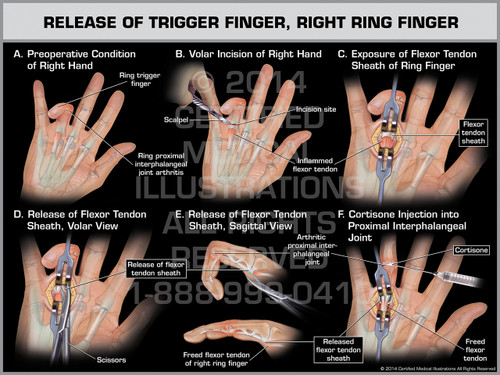 Release of Trigger Finger, Right Ring Finger