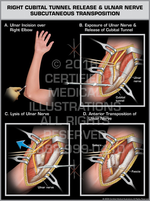 Right Cubital Tunnel Release & Ulnar Nerve Subcutaneous Transposition