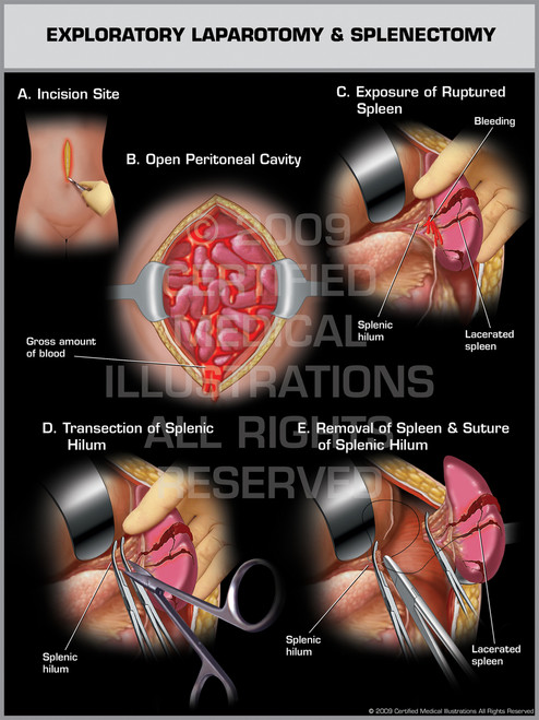 Exploratory Laparotomy & Splenectomy