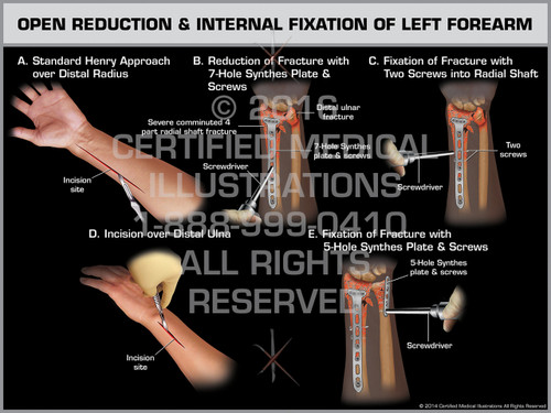 Open Reduction & Internal Fixation of Left Forearm