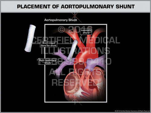 Placement of Aortopulmonary Shunt