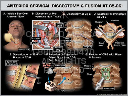 Anterior Cervical Discectomy & Fusion at C5-C6 - Print Quality Instant ...