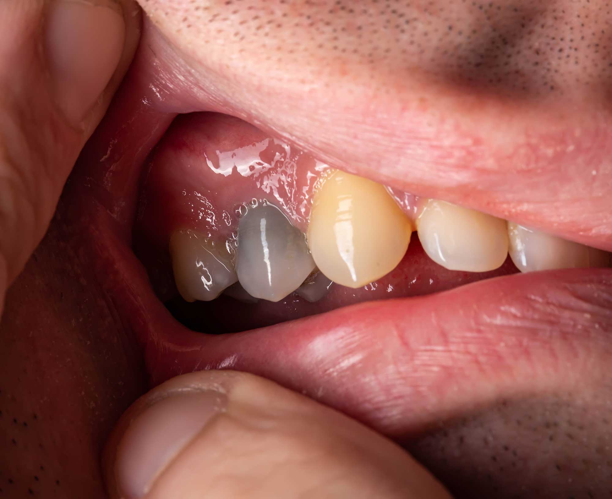 How Many Teeth In A Man's Mouth