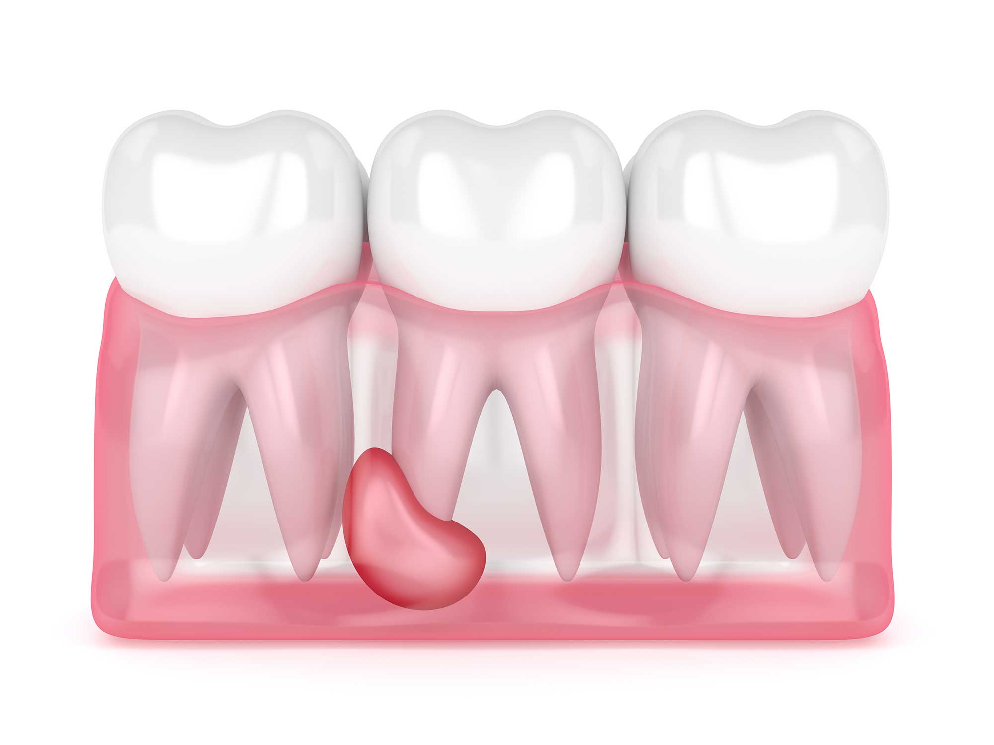 Gum Cyst: Causes, Symptoms, and Treatments - Oral-B