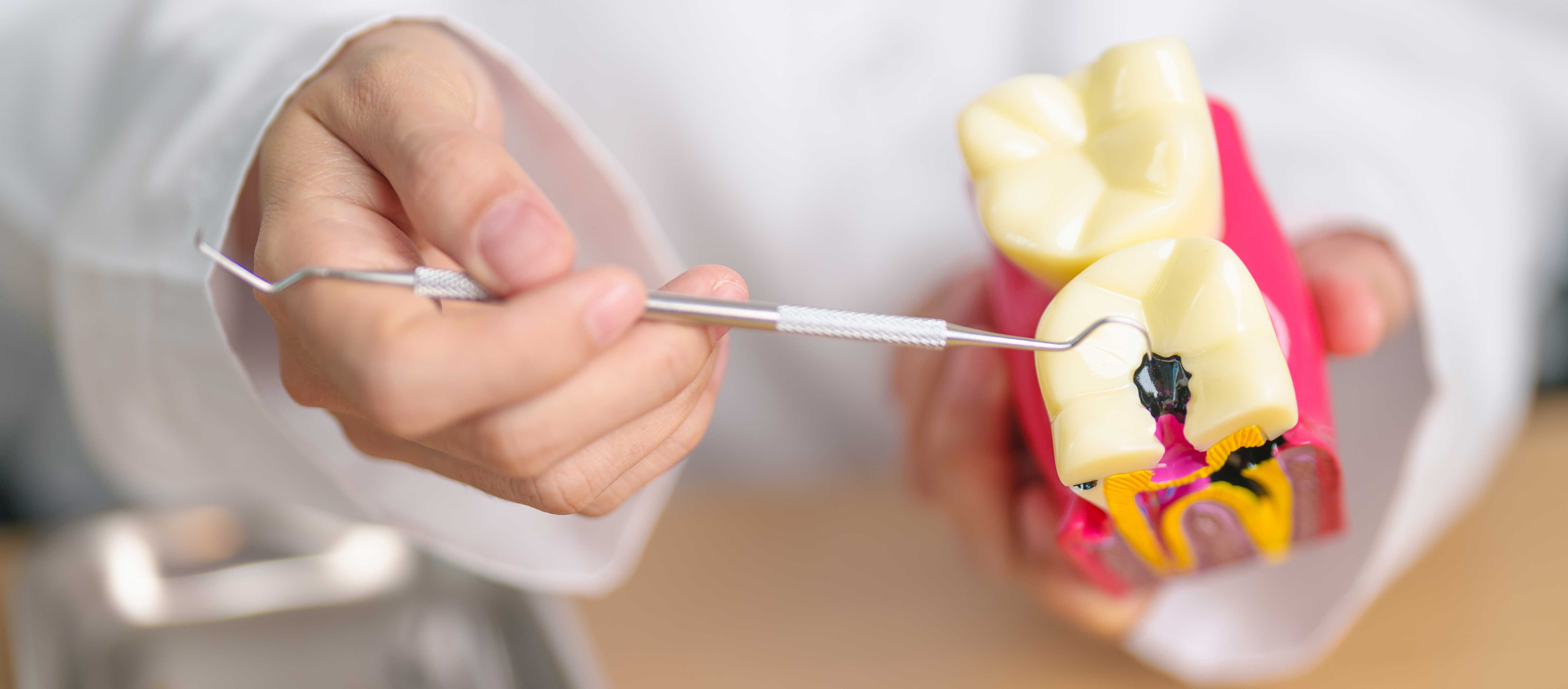 What Does a Cavity (Tooth Decay or Dental Caries) Look Like? - Oral-B