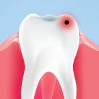 What are Dental Caries? Treatments, Signs, and Symptoms - Oral-B
