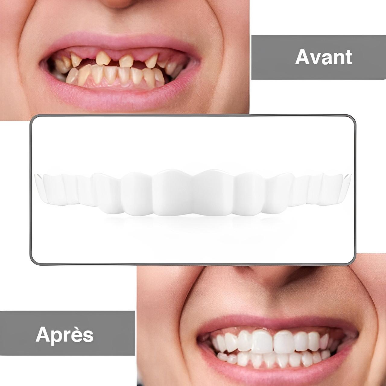 Facettes Dentaires à Clipser | Dents Parfaites - Esthétique Dentaire