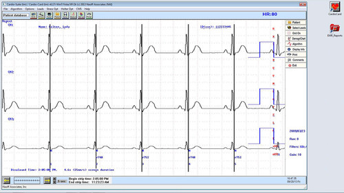 PC Based Cardio Holter 12-Lead Monitoring System