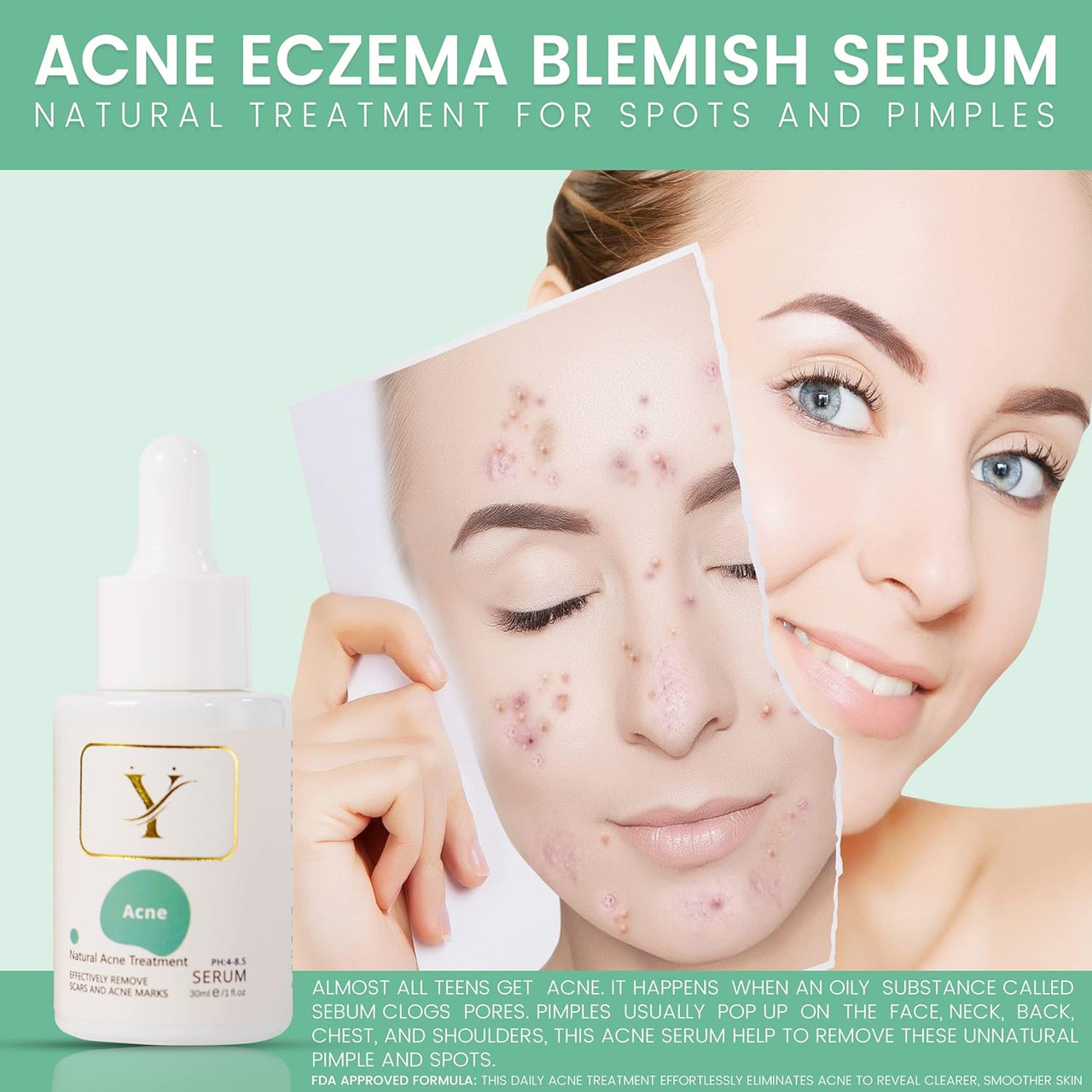 Acne Eczema blemish Serum Natural treatment for Spots and Pimples