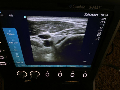 Sonosite Hfl38X Linear Transducer For M-Turbo And Edge S-Series System ...