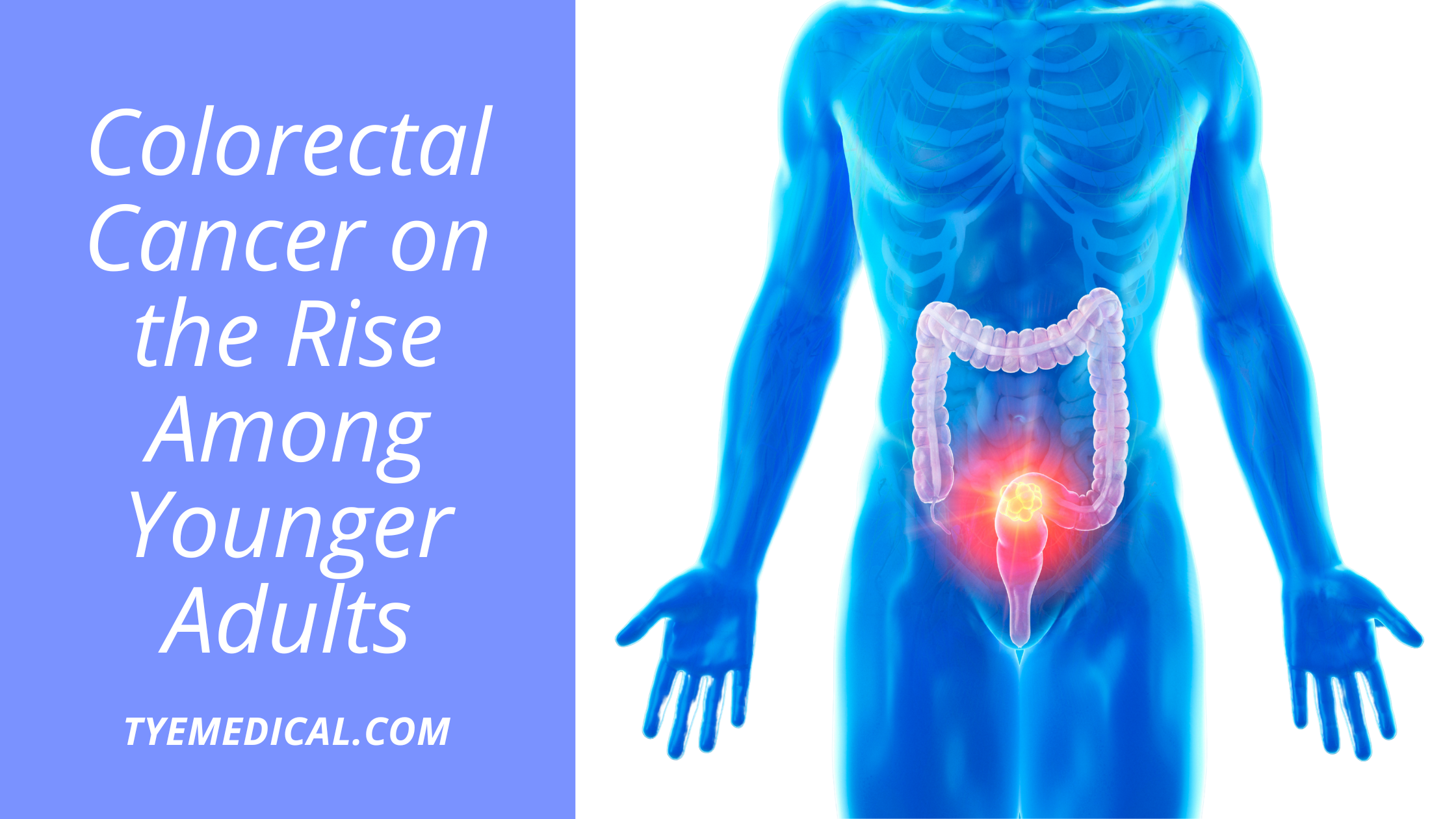 Colorectal Cancer on the Rise Among Younger Adults: Signs to Know - TYE ...
