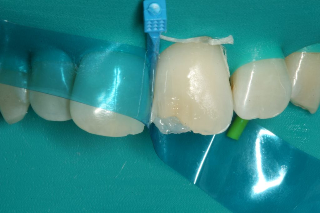 G-Wedge™ Interproximal Wedge Kit (qty. 100 of each colour)