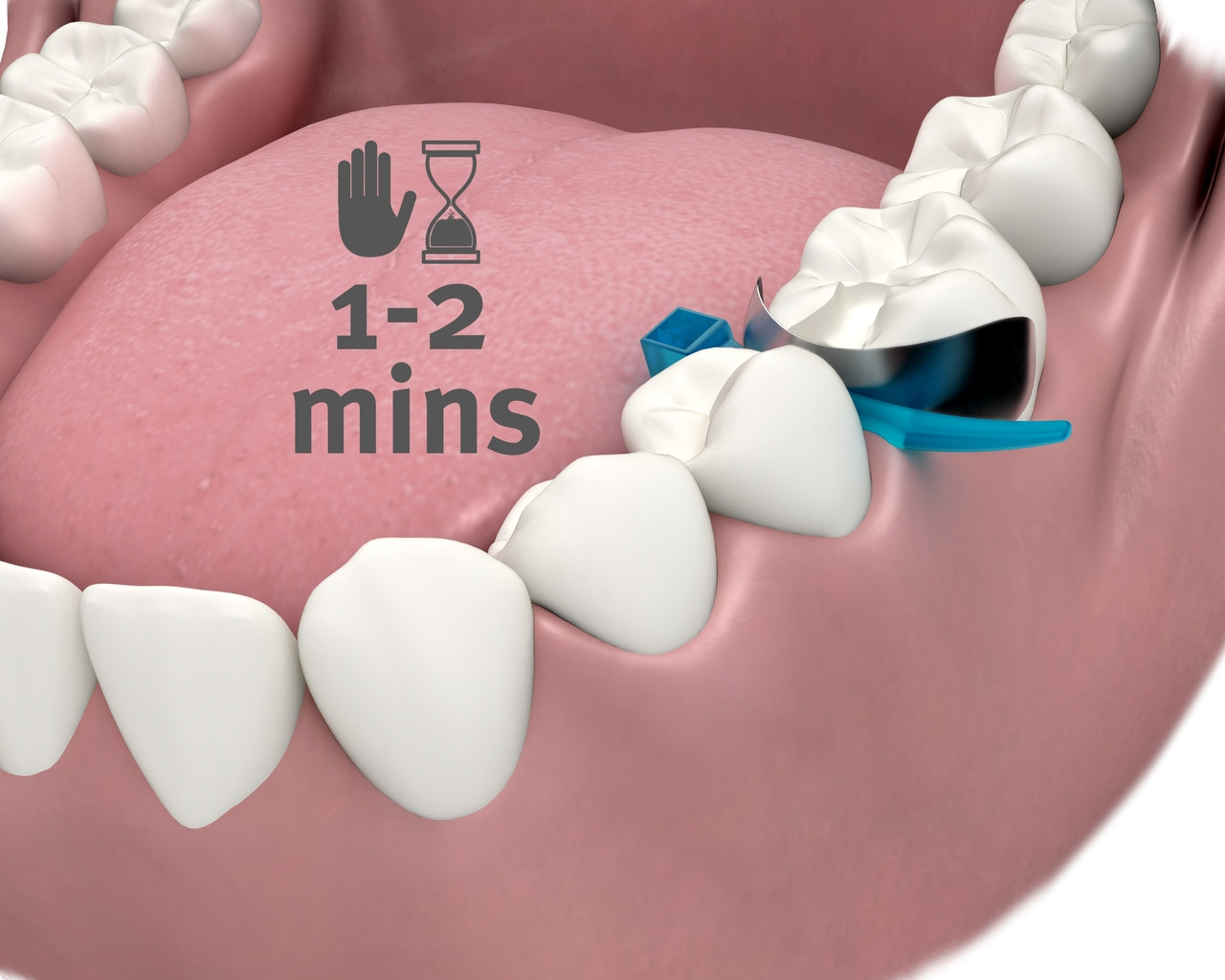 A+ Wedge™ Astringent Interproximal Wedge Kit