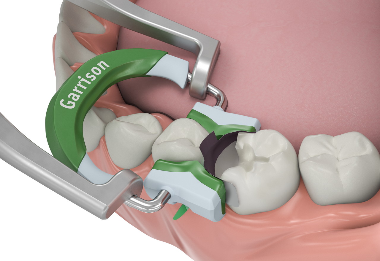 Composi-Tight® 3D Fusion™ Ring Kit (1 of each)