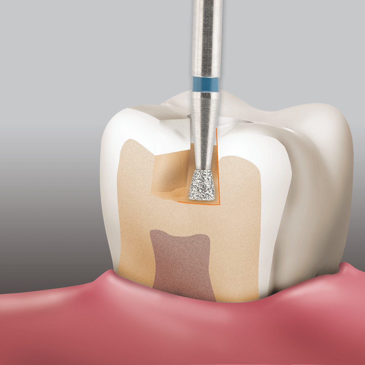 805 Diamond Bur Inverted cone (FG)