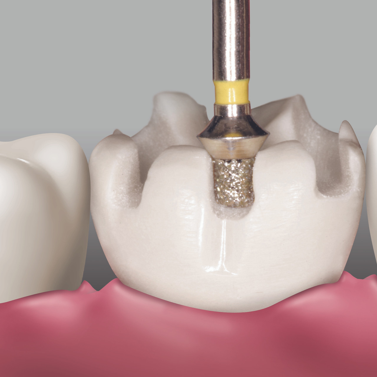 828TW Diamond Bur Occlusal Reduction (FG)